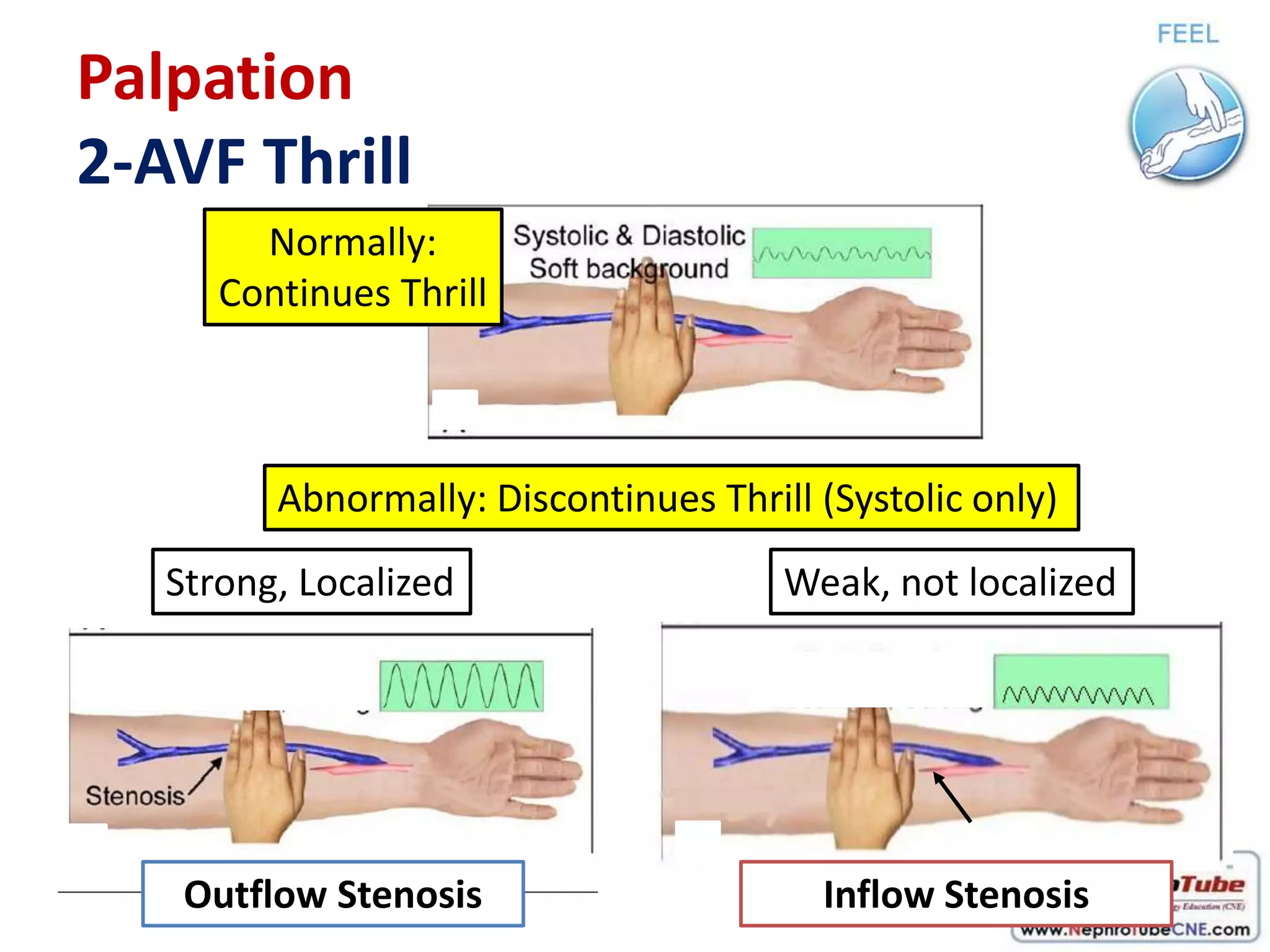 How to examine AVF in 10 minutes - Dr. Gawad | PPTX