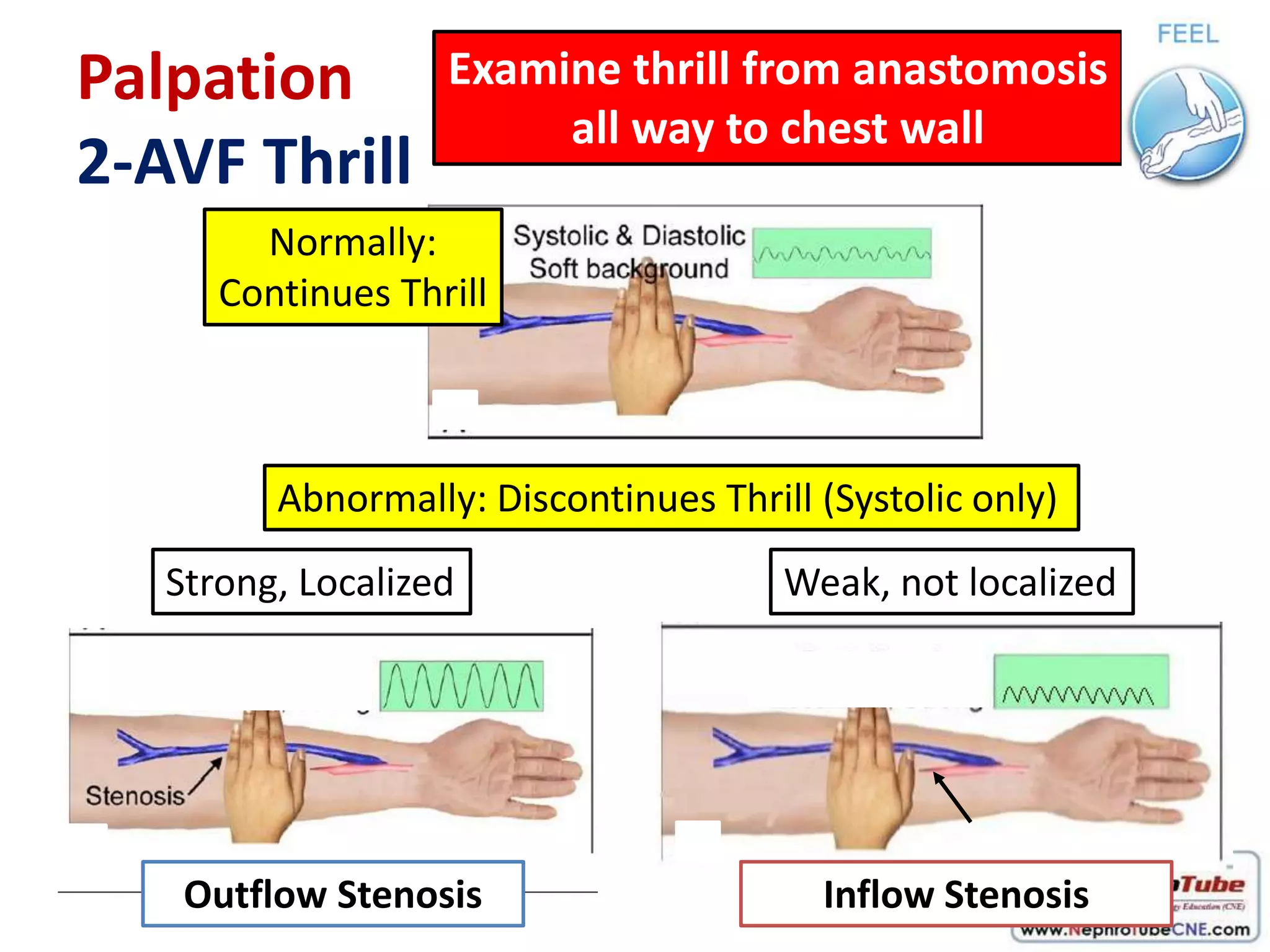 How to examine AVF in 10 minutes - Dr. Gawad | PPTX
