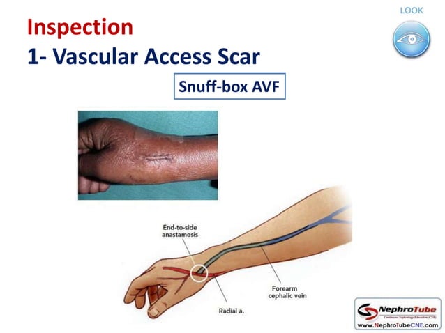 How to examine AVF in 10 minutes - Dr. Gawad | PPTX | Blood Disorders ...