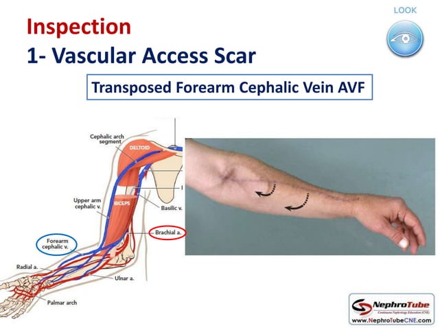 How to examine AVF in 10 minutes - Dr. Gawad | PPTX | Blood Disorders ...
