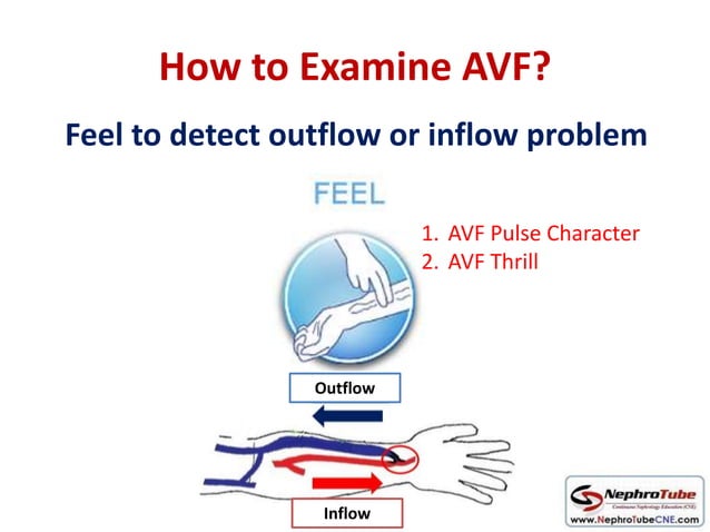 How to examine AVF in 10 minutes - Dr. Gawad | PPTX | Blood Disorders ...