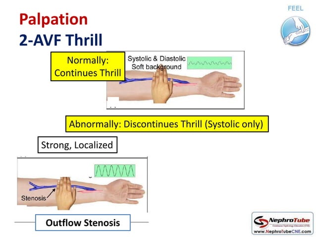 How to examine AVF in 10 minutes - Dr. Gawad | PPTX | Blood Disorders ...