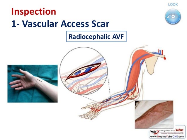 How to examine AVF in 10 minutes