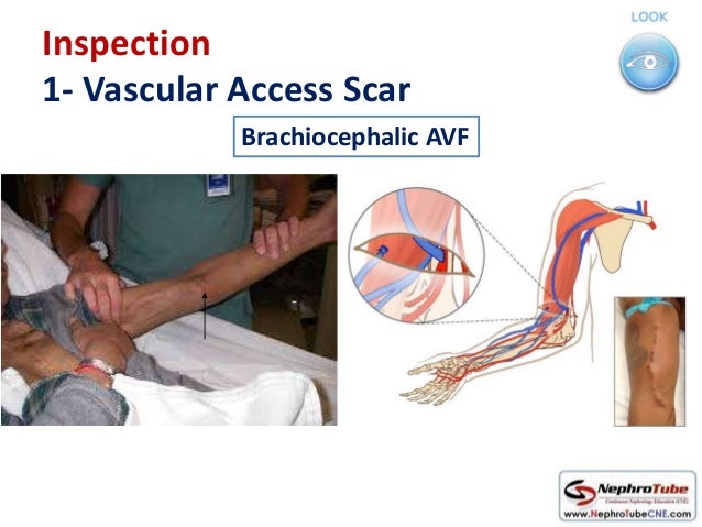 How to examine AVF in 10 minutes