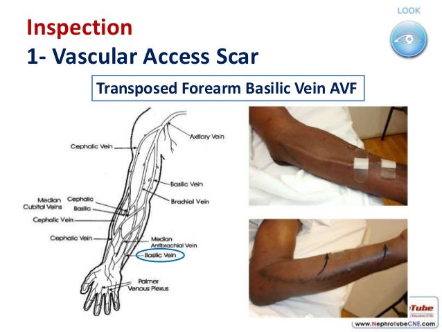 How to examine AVF in 10 minutes