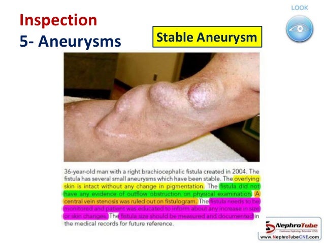 How to examine AVF in 10 minutes