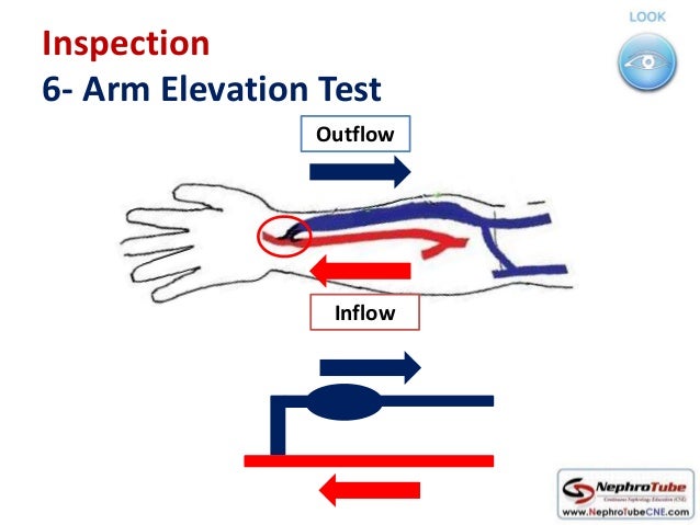 How to examine AVF in 10 minutes
