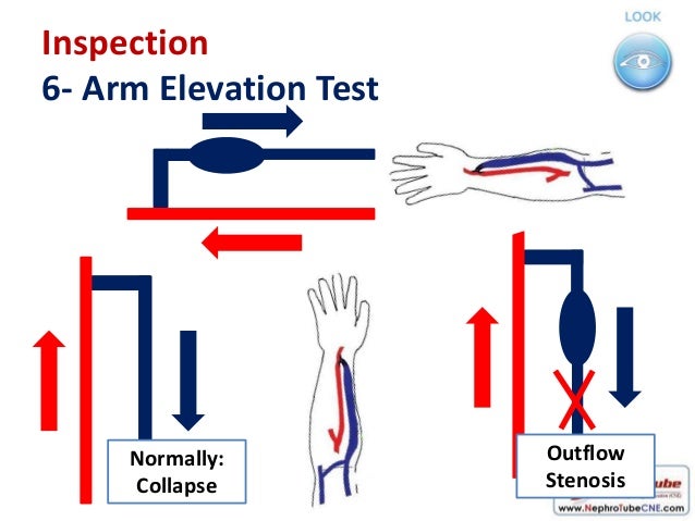 How to examine AVF in 10 minutes