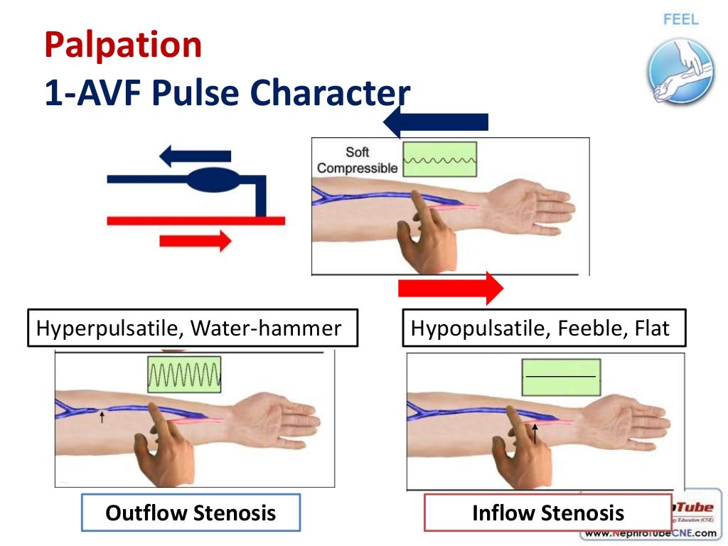 How to examine AVF in 10 minutes