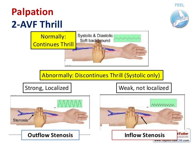 How to examine AVF vin 10 minutes