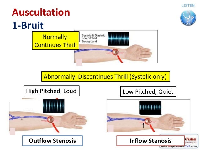 How to examine AVF in 10 minutes
