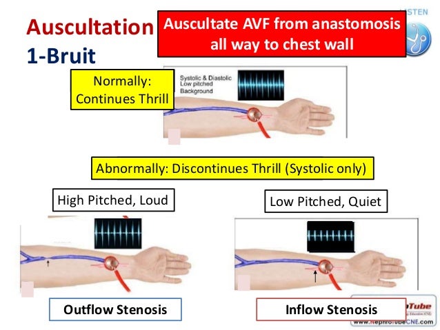 How to examine AVF in 10 minutes