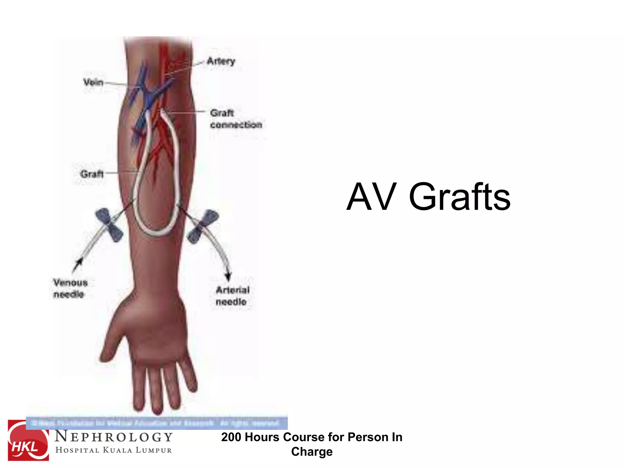 Av grafts and hemodialysis catheters vistana | PPTX