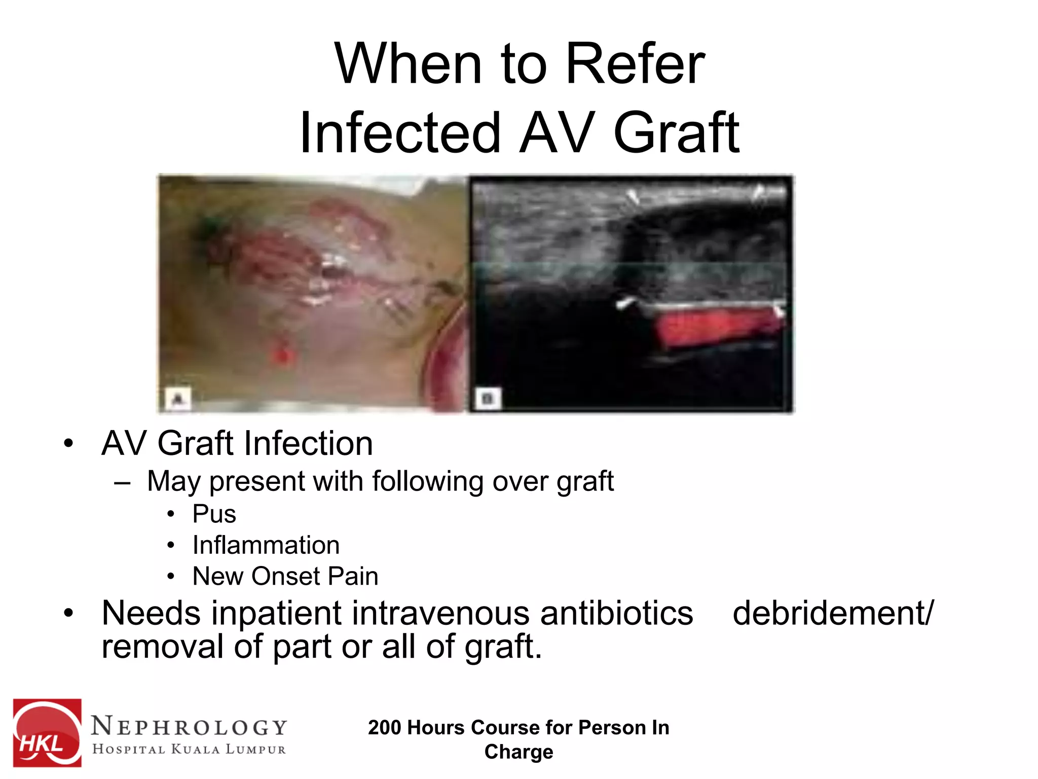 Av grafts and hemodialysis catheters vistana | PPTX