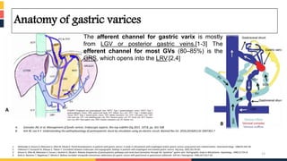 Acute Variceal Hemorrhage | PPTX