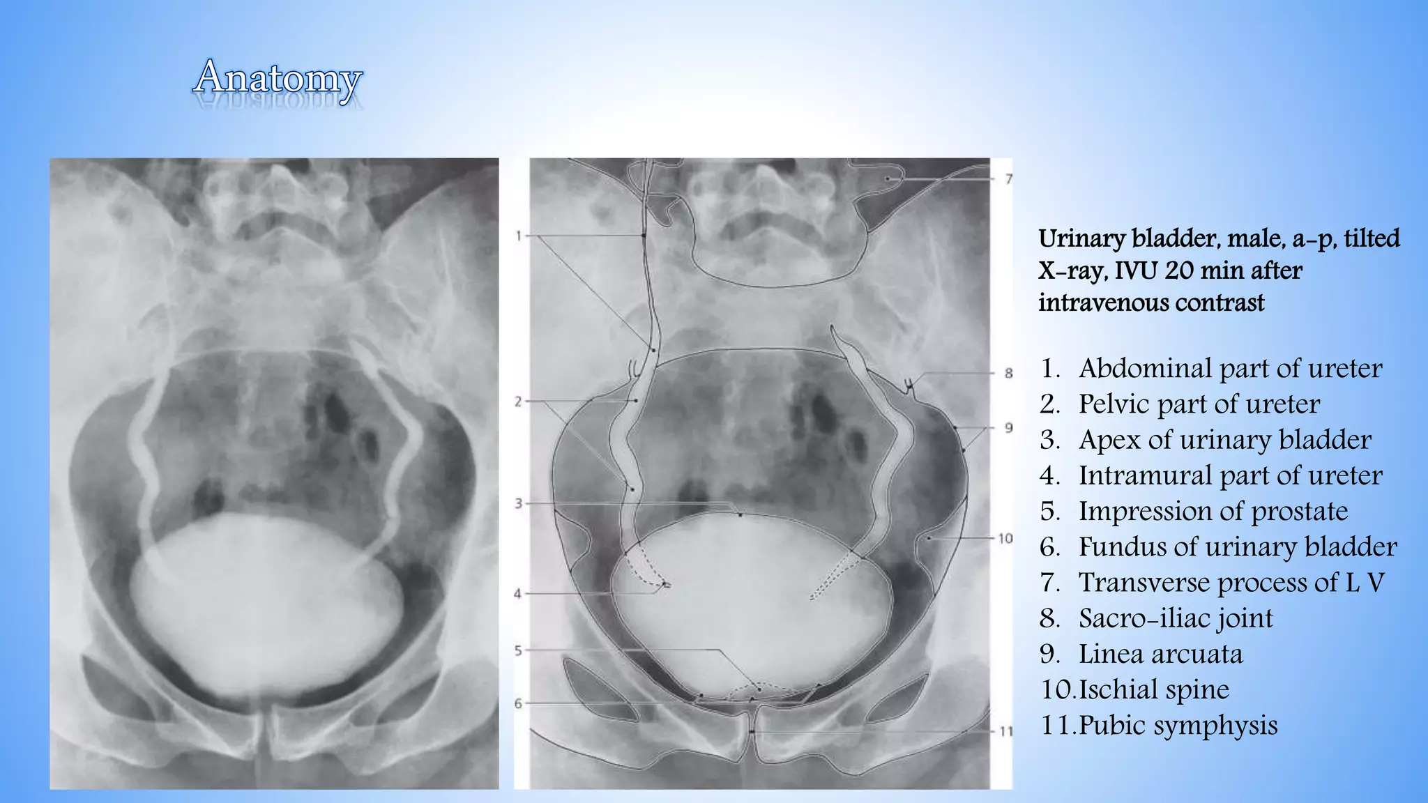 Intravenous urography (IVU)- Avinesh Shrestha | PPTX