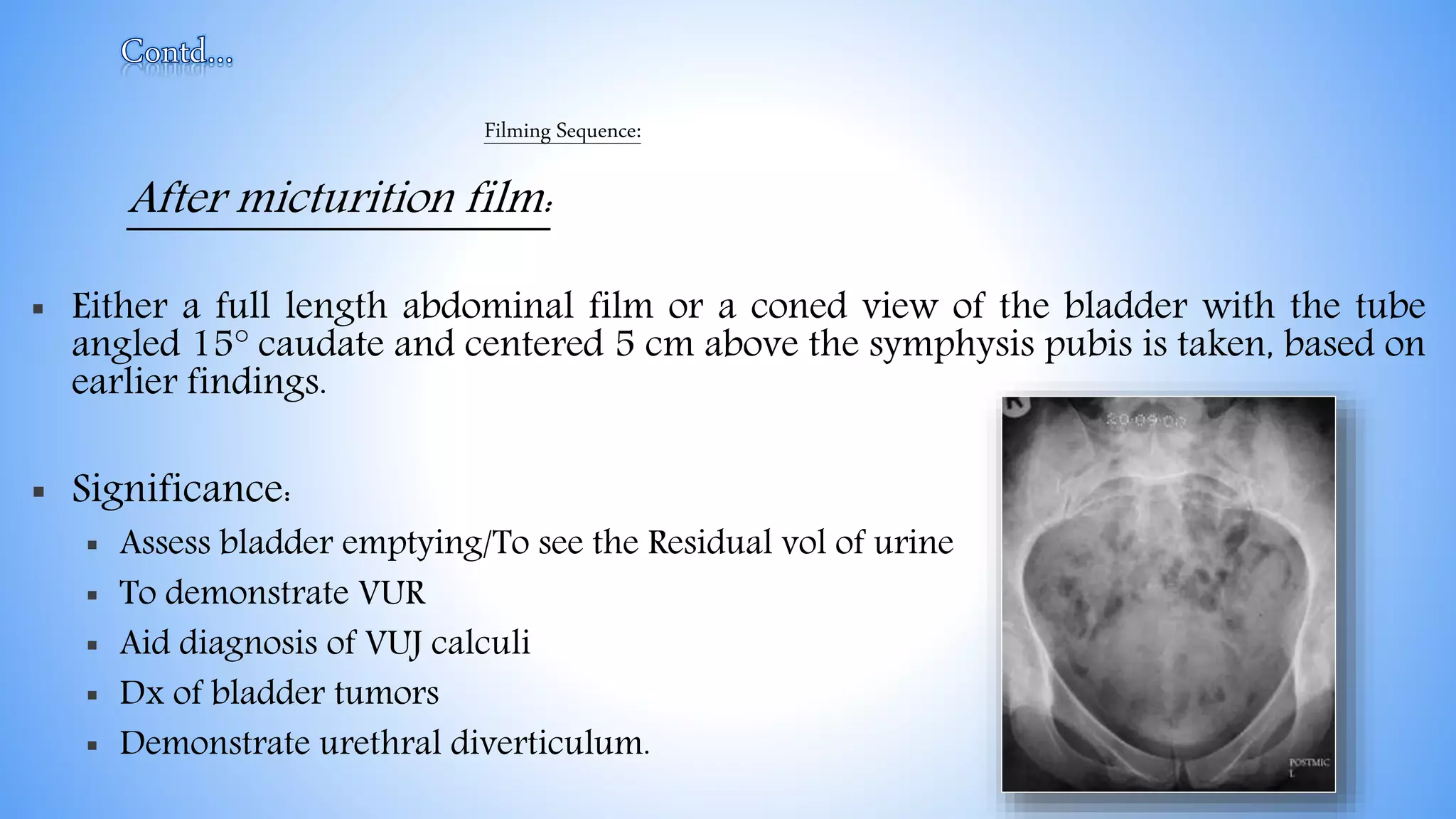 Intravenous urography (IVU)- Avinesh Shrestha | PPTX
