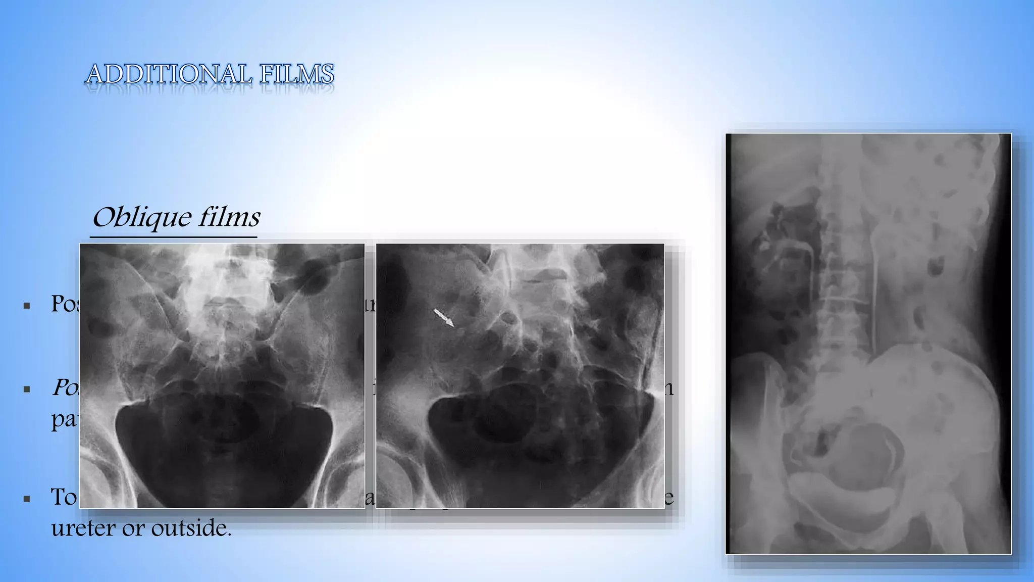 Intravenous urography (IVU)- Avinesh Shrestha | PPTX