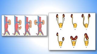 Intravenous urography (IVU)- Avinesh Shrestha | PPTX