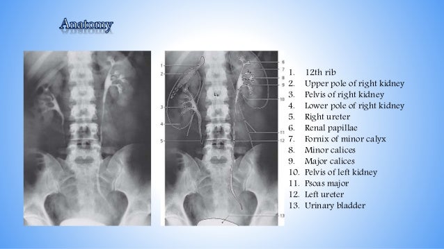 Intravenous urography ,(ivu)