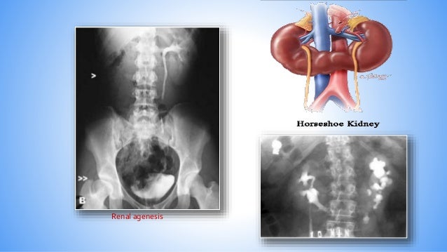 Horseshoe Kidneys Intravenous Pyelogram