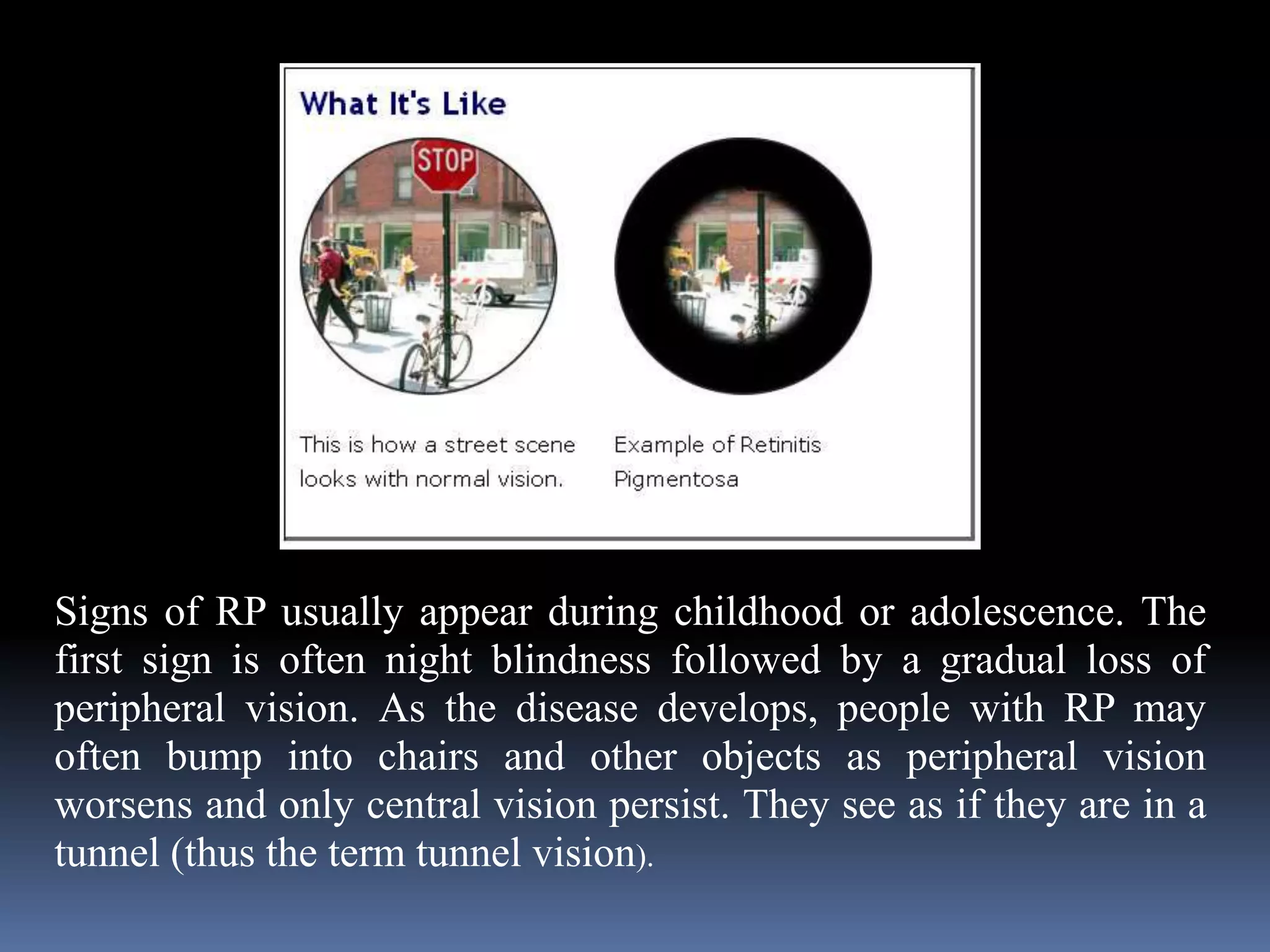 case presentation on retinitis pigmentosa (low vision aid) | PPTX