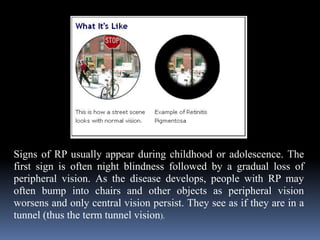 case presentation on retinitis pigmentosa (low vision aid) | PPT