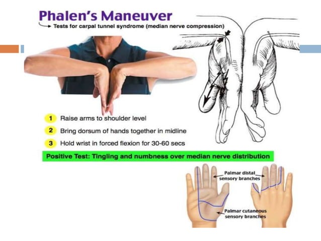 carpal tunnel syndrome - hand surgery | PPT