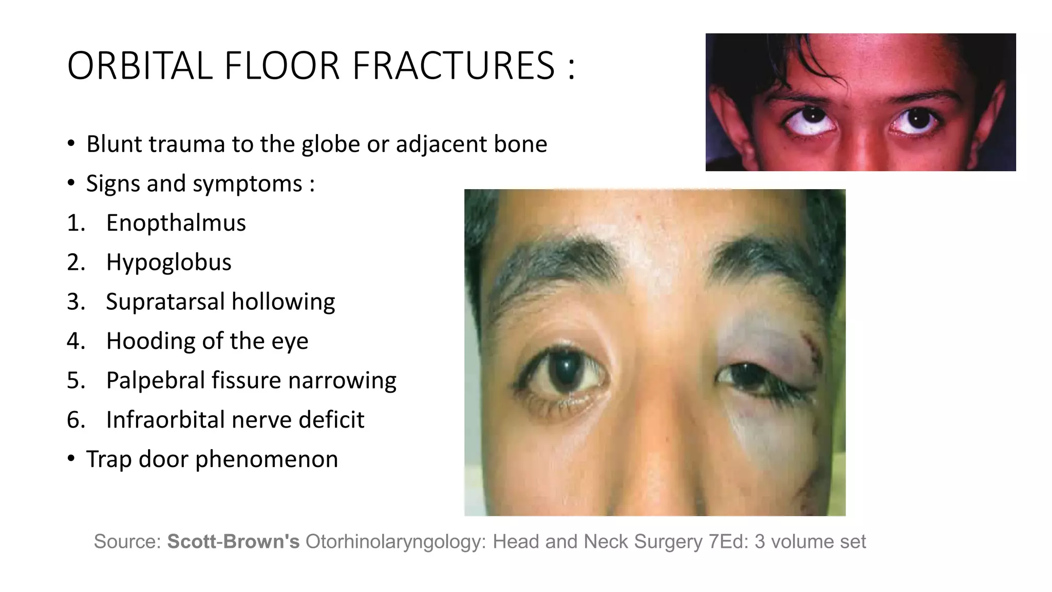 Facial Fractures | PPTX