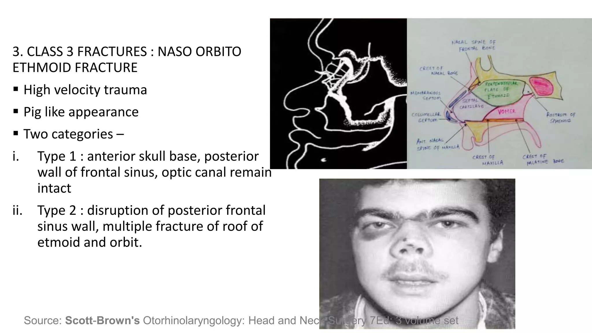 Facial Fractures | PPTX