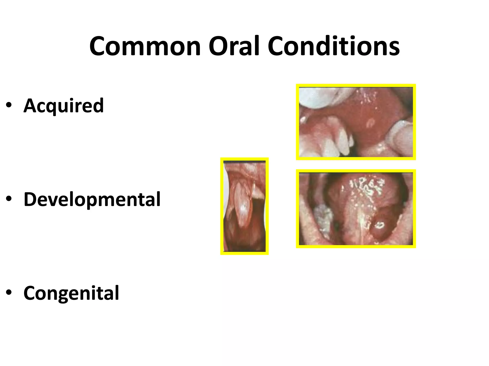 A viral infections of mouth | PDF