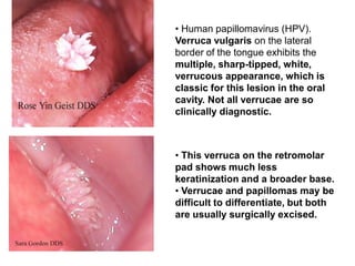 Oral Verruca Vulgaris