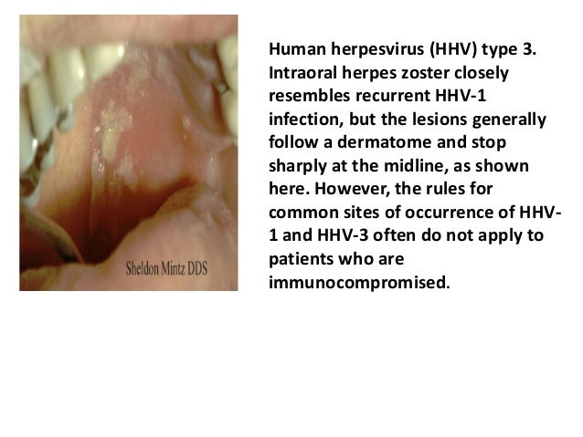 A viral infections of mouth