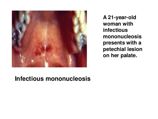 A viral infections of mouth