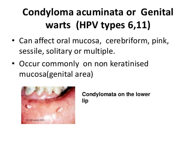 Oral Warts Under Tongue