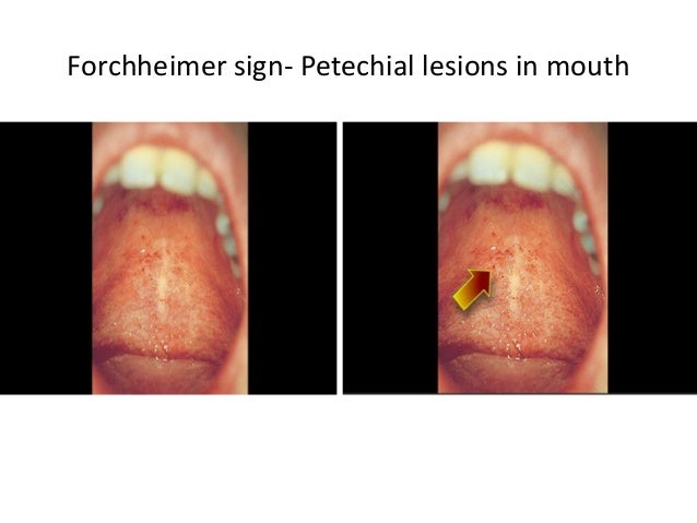 A viral infections of mouth