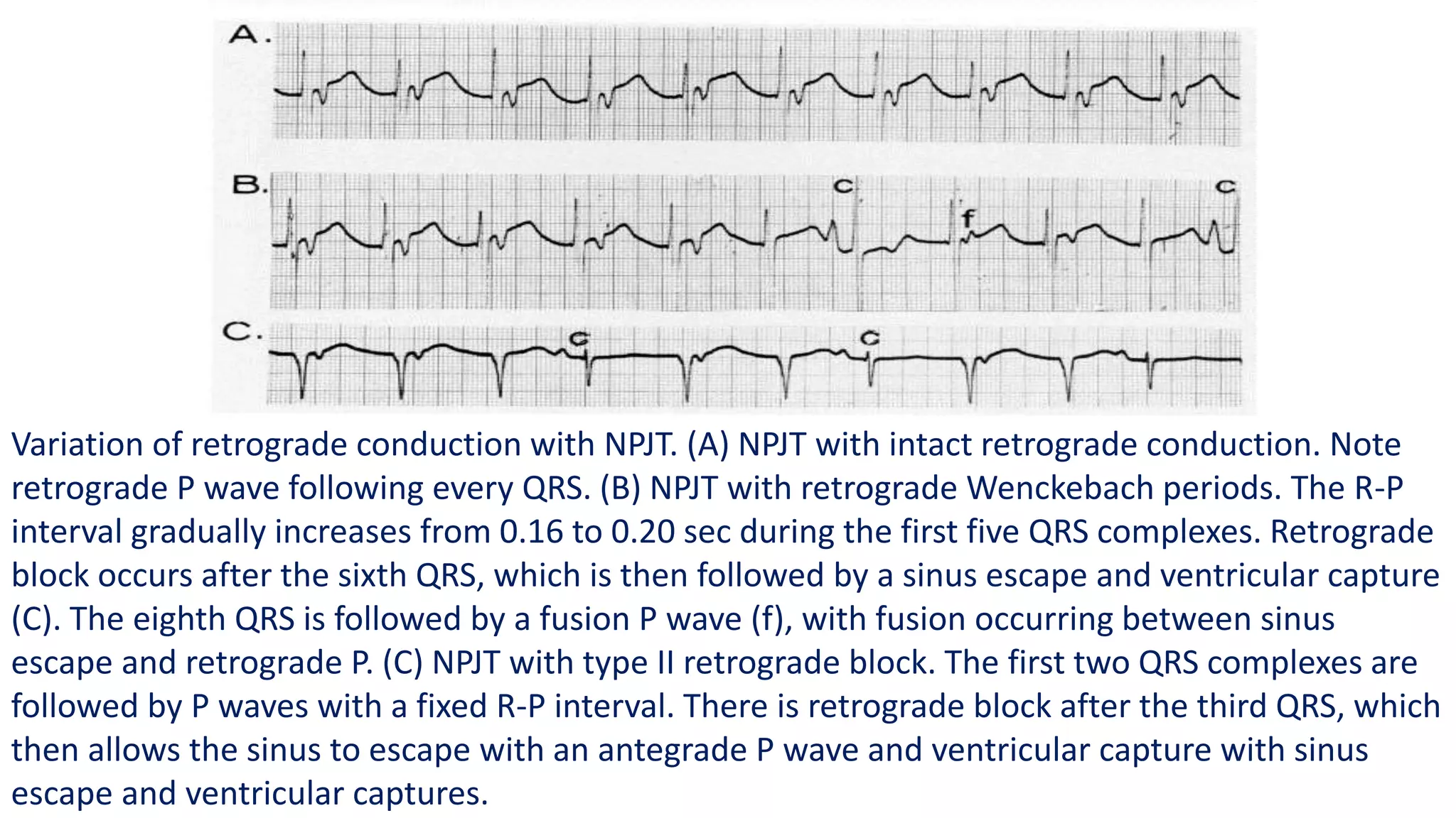 AV junctional Rhythm disturbances.pptx
