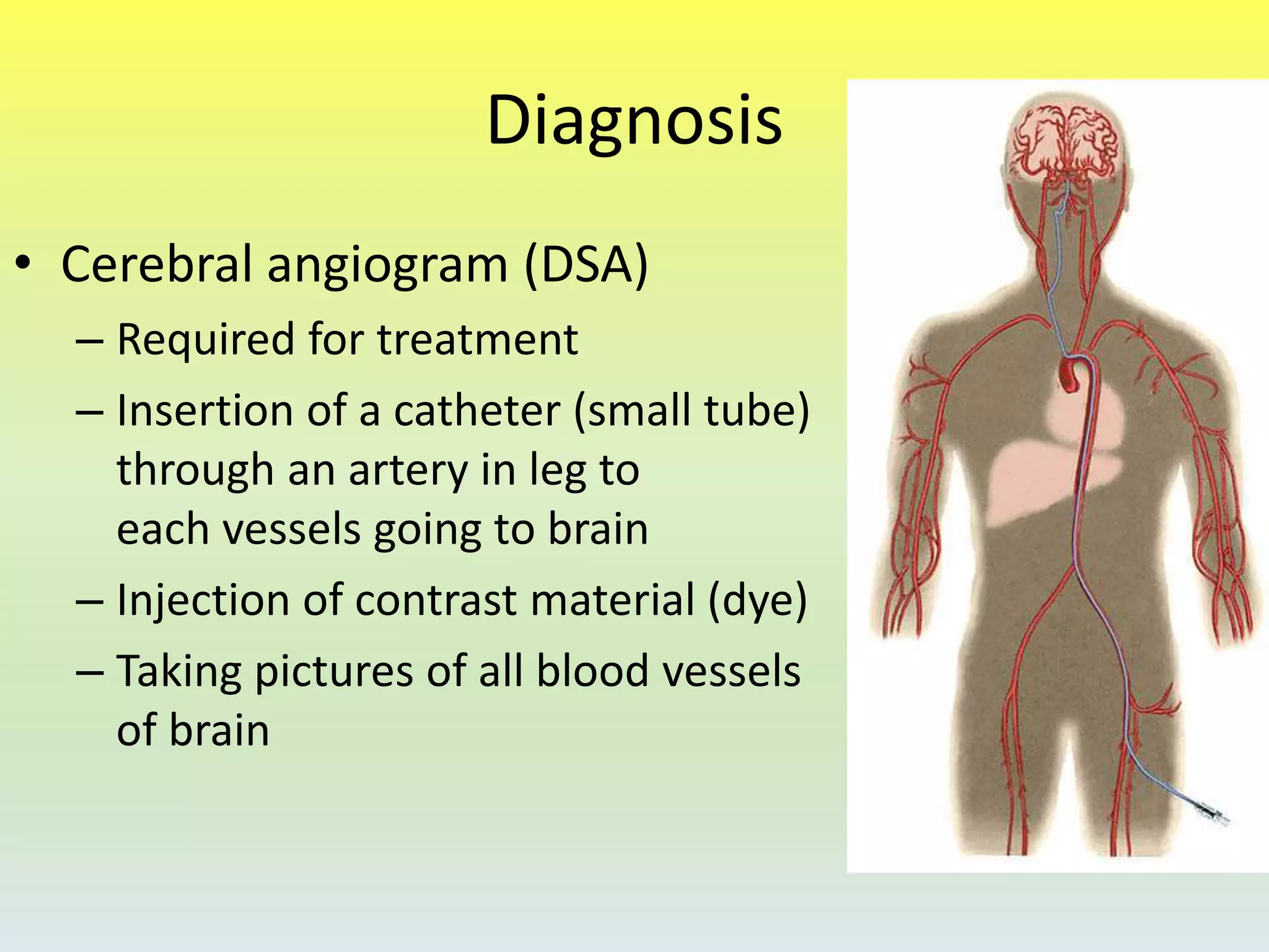 Arteriovenous Malformation (AVM) of Brain | PPTX
