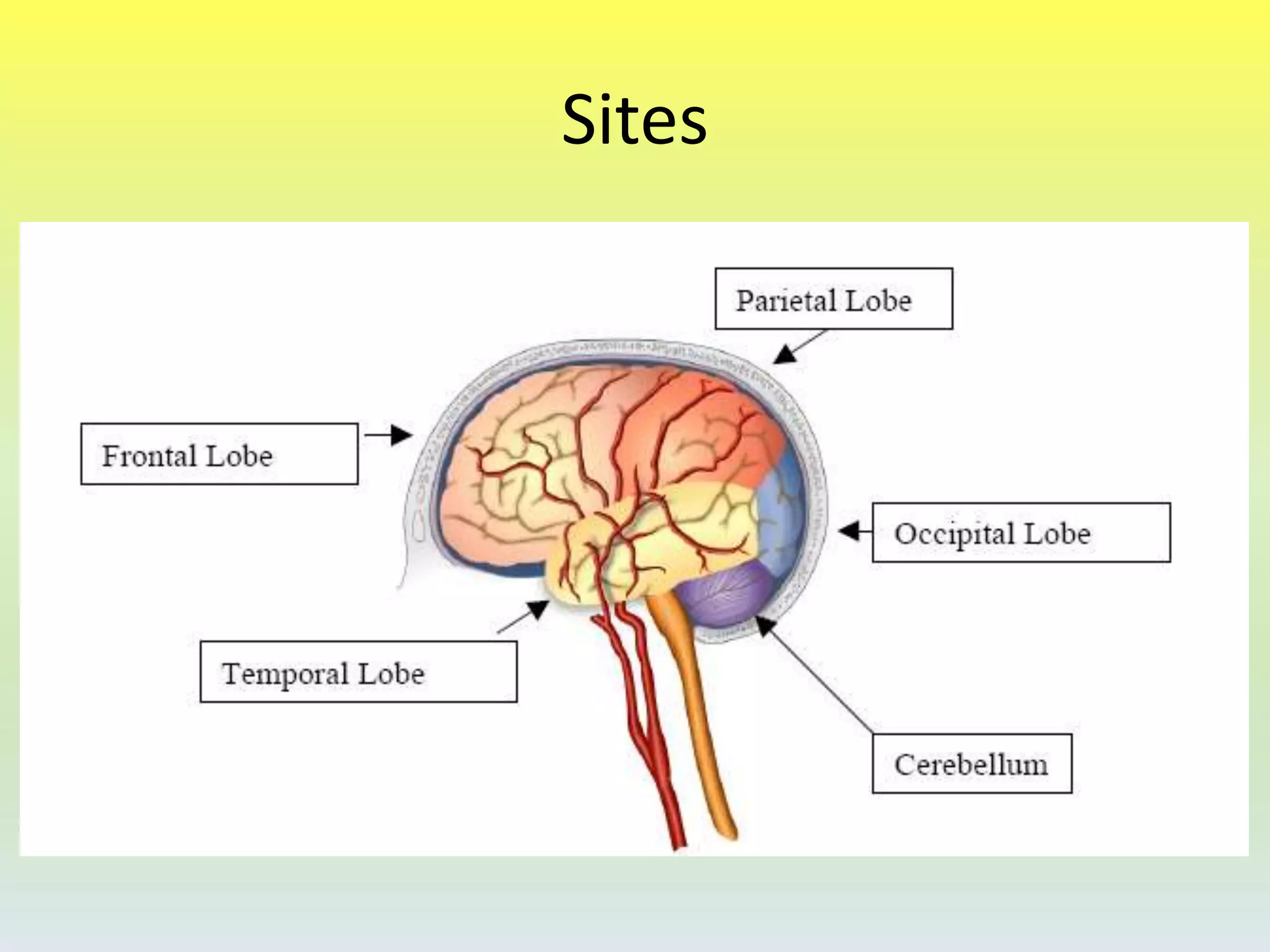 Arteriovenous Malformation (AVM) of Brain | PPTX