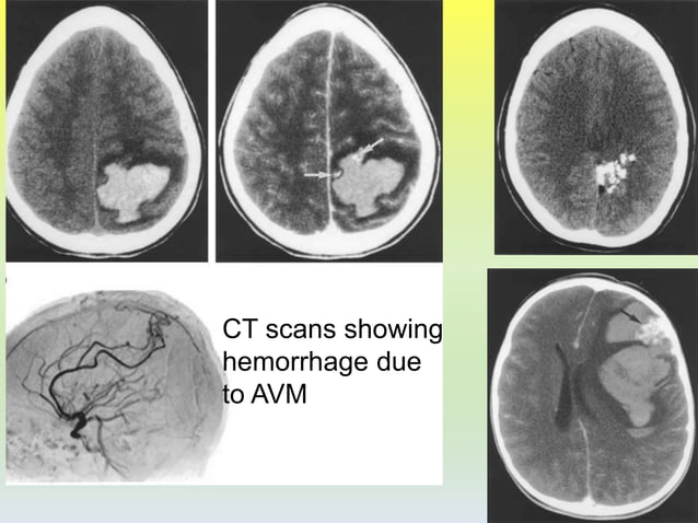 Arteriovenous Malformation (AVM) of Brain | PPTX
