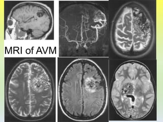 Arteriovenous Malformation (AVM) of Brain | PPTX