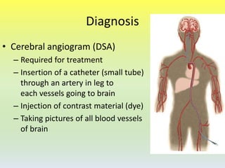 Arteriovenous Malformation (AVM) of Brain | PPTX