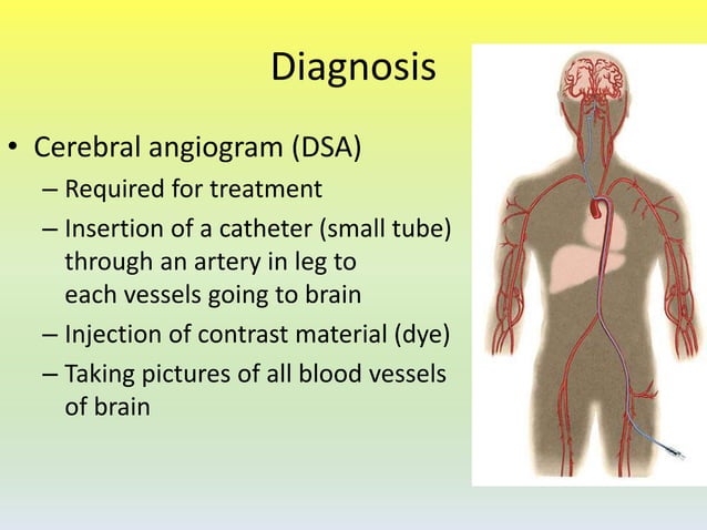 Arteriovenous Malformation (AVM) of Brain | PPTX