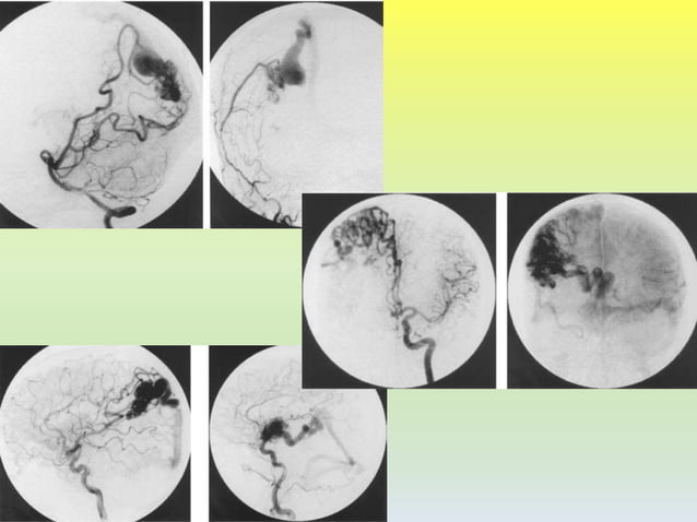 Arteriovenous Malformation (AVM) of Brain | PPTX