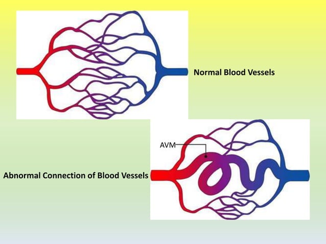 Arteriovenous Malformation (AVM) of Brain | PPTX