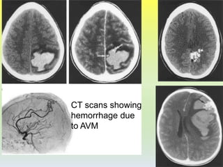 Avm Brain Hemorrhage