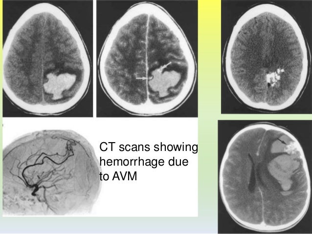 Arteriovenous Malformation (AVM) of Brain