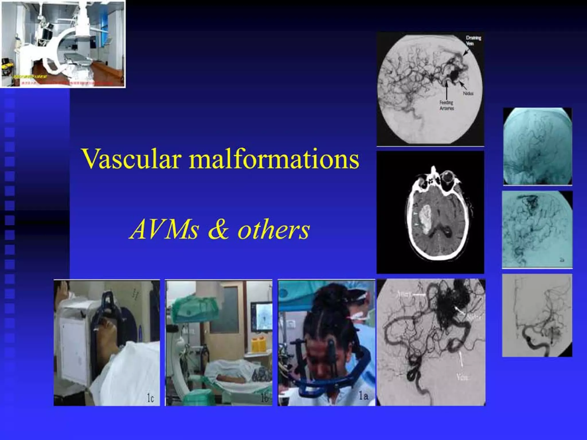 AVM, Vascular Malformation | PDF