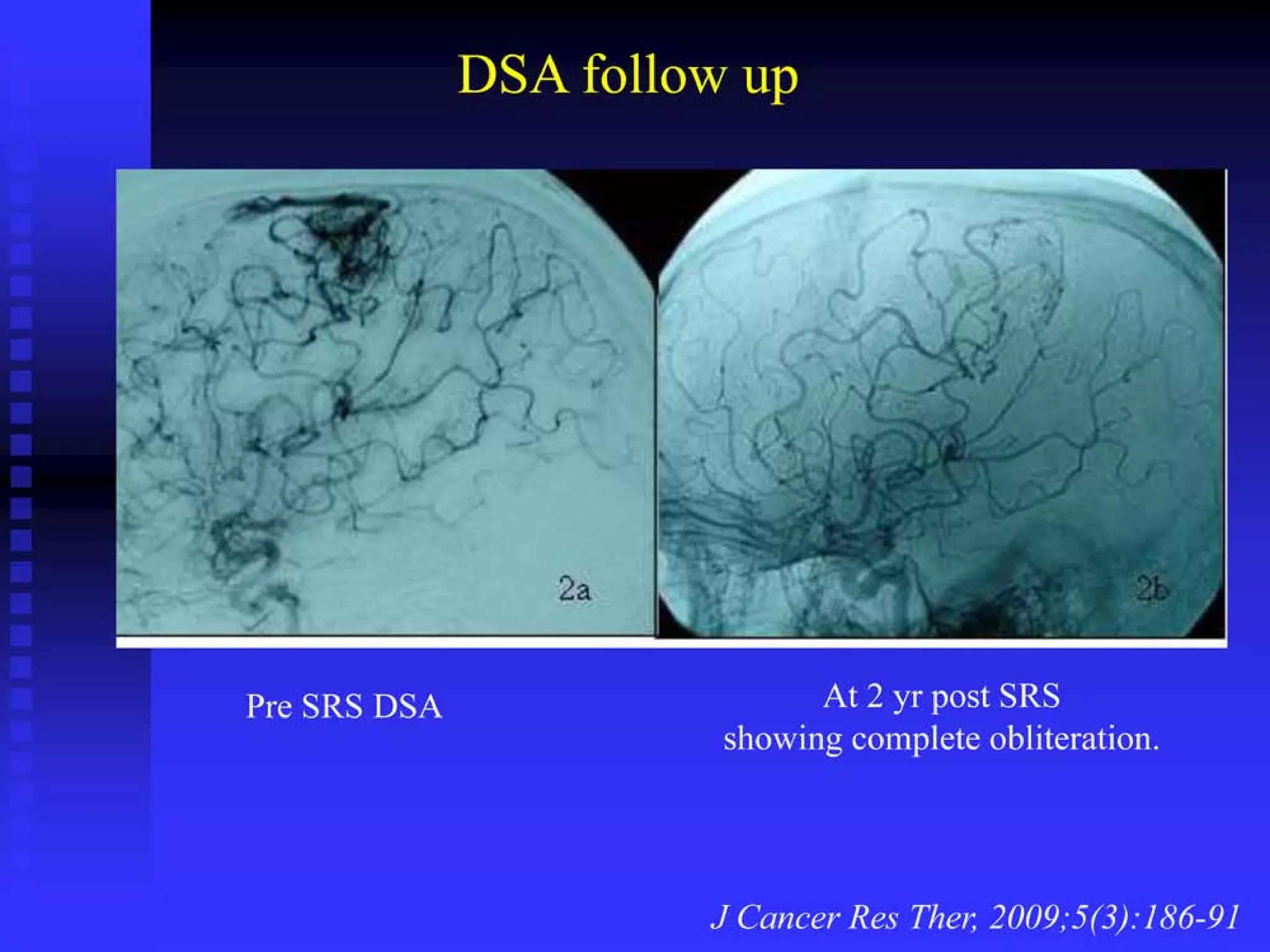 AVM, Vascular Malformation | PDF
