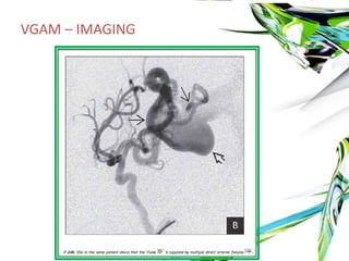 Vascular Malformations Of CNS Radiology | PPTX